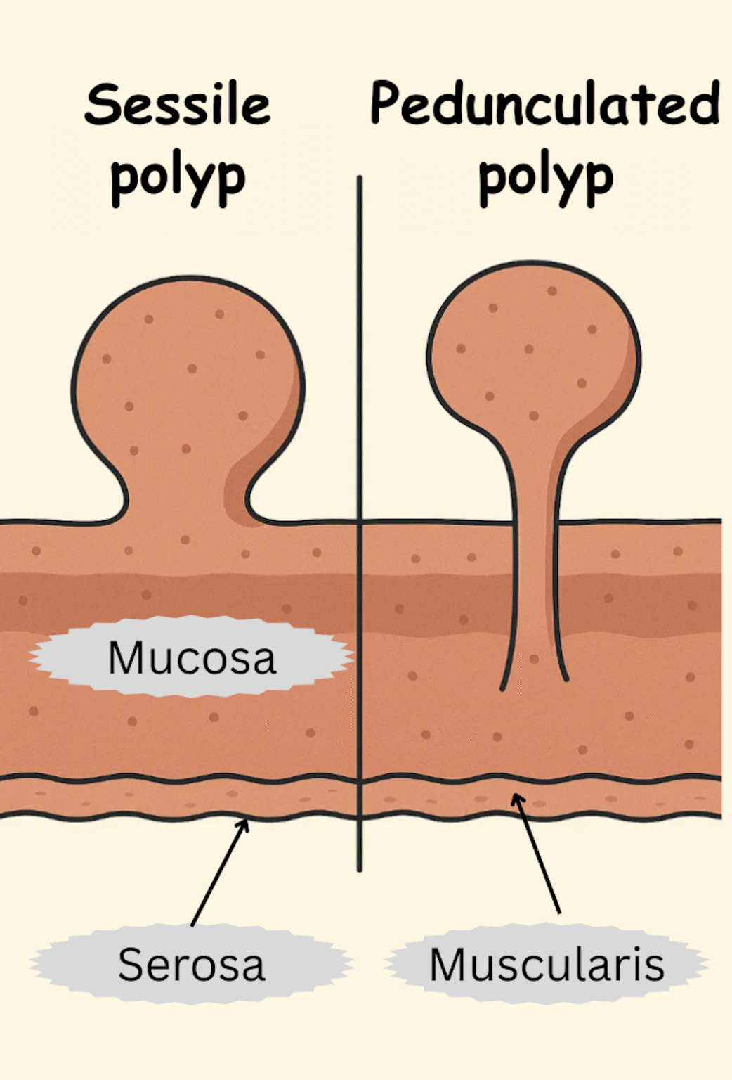 Sessile vs Pedunculated Colon Polyps: A Simple Guide for Students