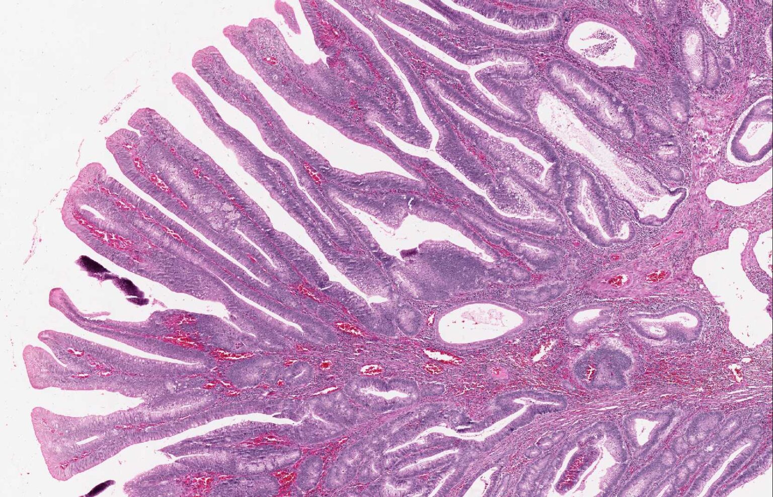 Sessile vs Pedunculated Colon Polyps: A Simple Guide for Students