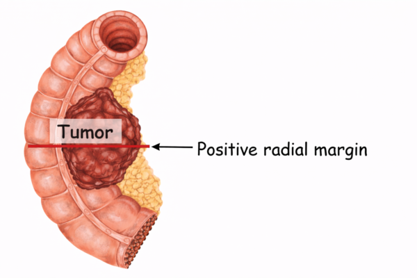 What Is a Radial Margin in Colon Cancer? - Canadian Path Assistant