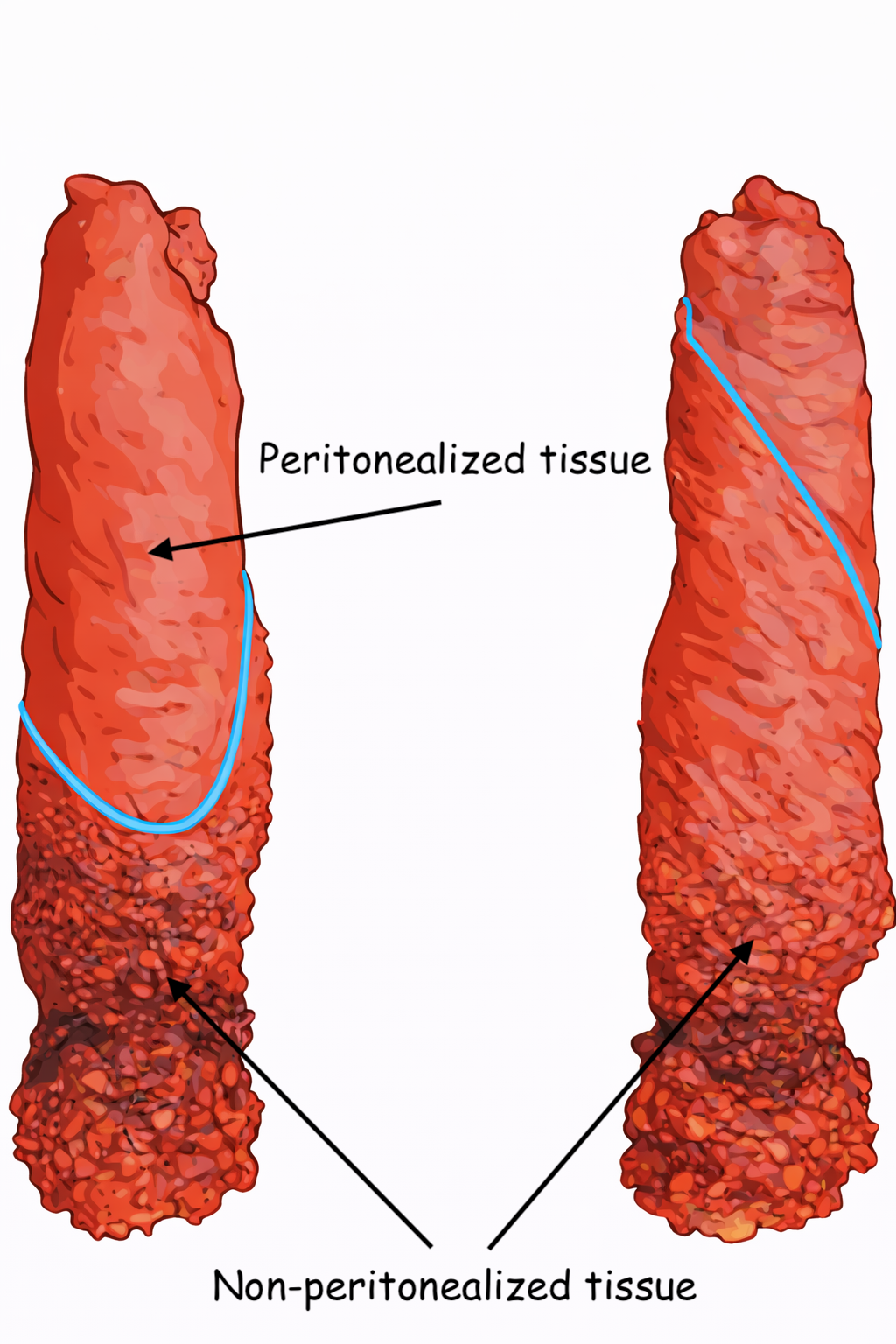 What Is a Radial Margin in Colon Cancer? - Canadian Path Assistant